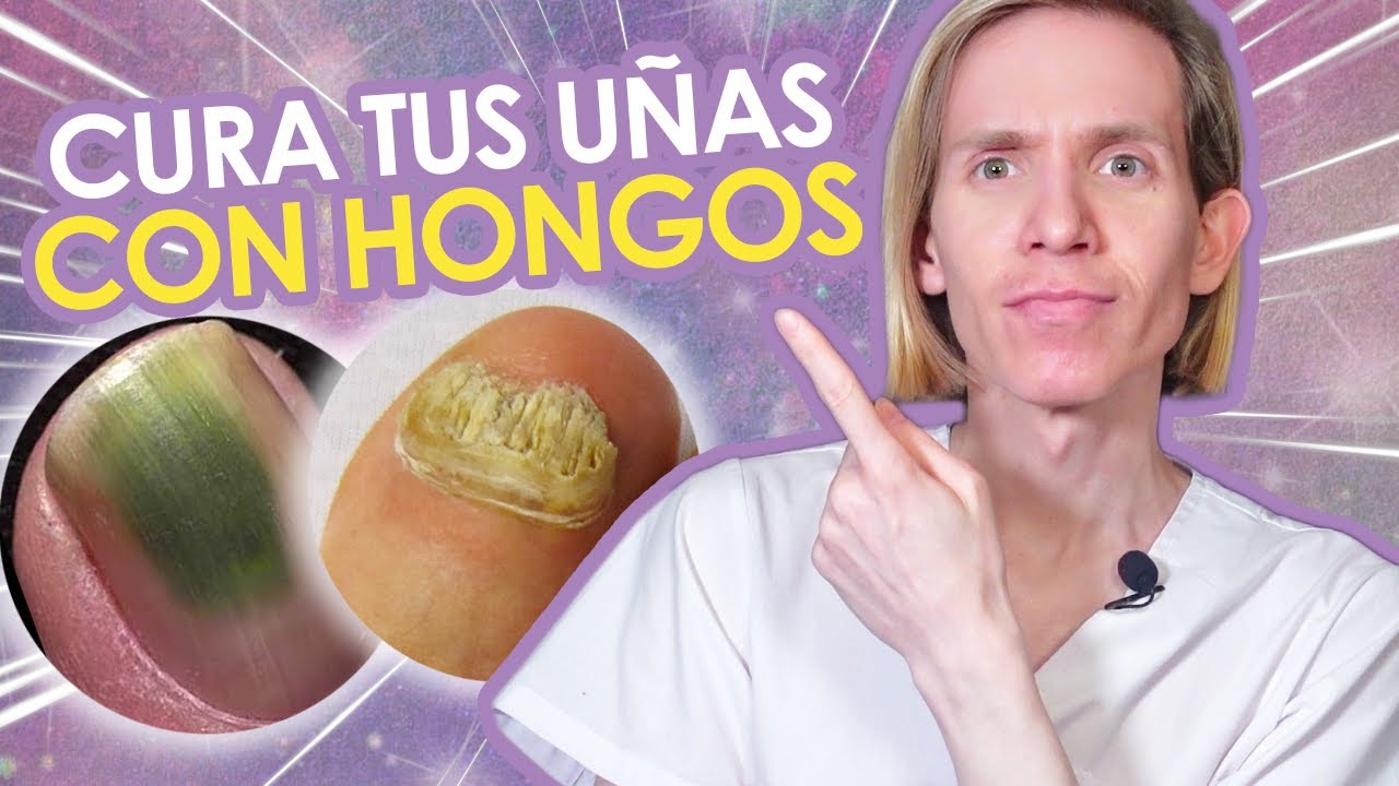 🥇 Problemas comunes de hongos en las uñas de los pies: cómo identificar ...